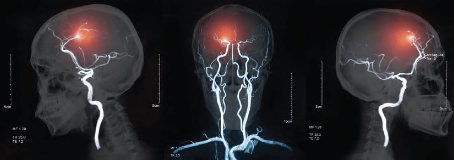 The Neuroscience Behind Stroke - TBI Times